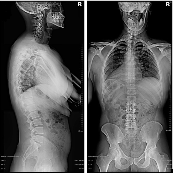 4 Reasons Why X-Rays Are Important When You Have Neck or Back Pain - Dr ...
